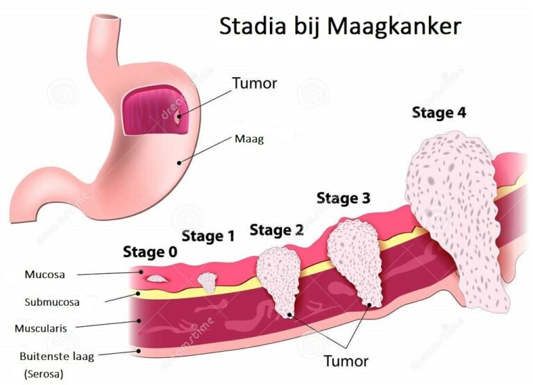 Maagkanker - Centrum Hyperthermie